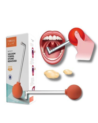 TonsilClin® Schröpfglas | Mandelsteine in 1 Minute entfernt